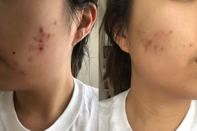 Curology acne scars store