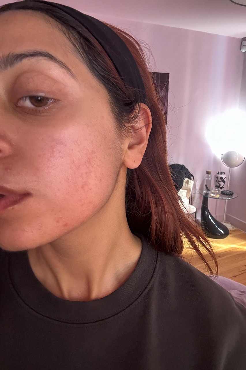 An Honest Review of the Astro Facial | Hypebae
