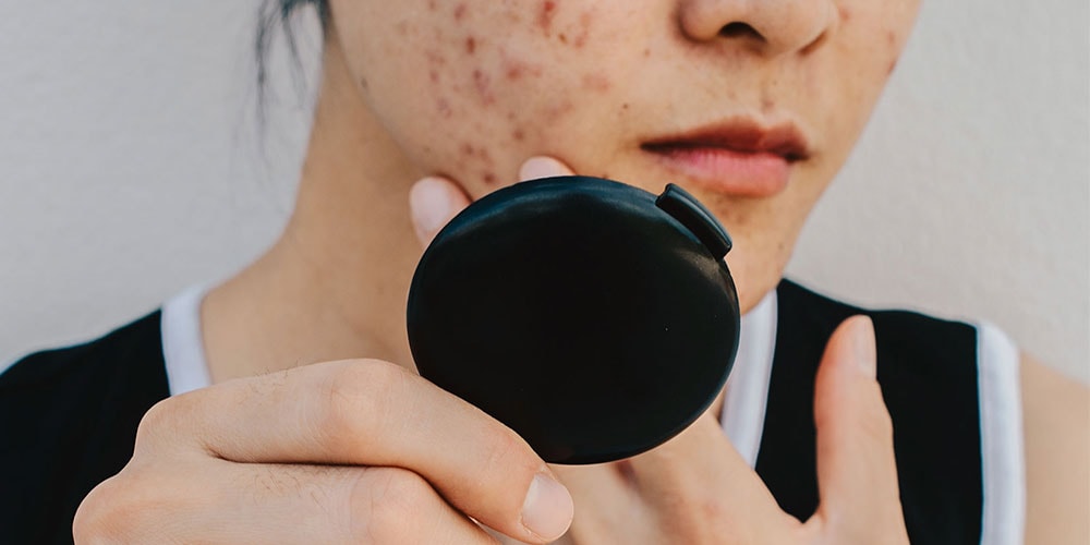 The Effects of Anxiety & Stress on the Skin | Hypebae